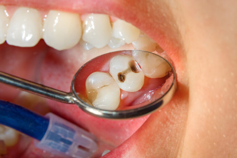 What Does a Cavity Look Like? Learn How to Identify It